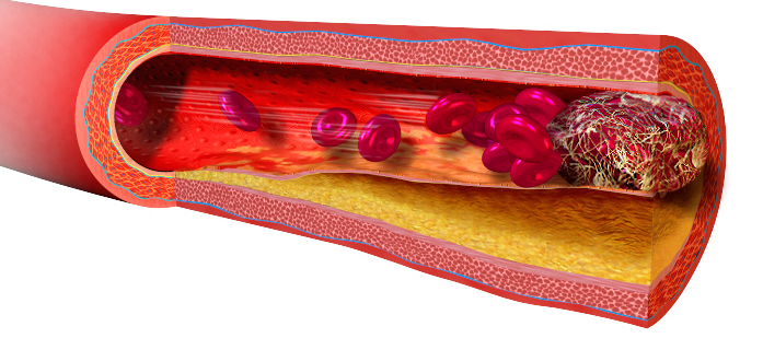 Blausen_0089_BloodClot_Motion – Angiología, Cirugía Vascular y Endovascular