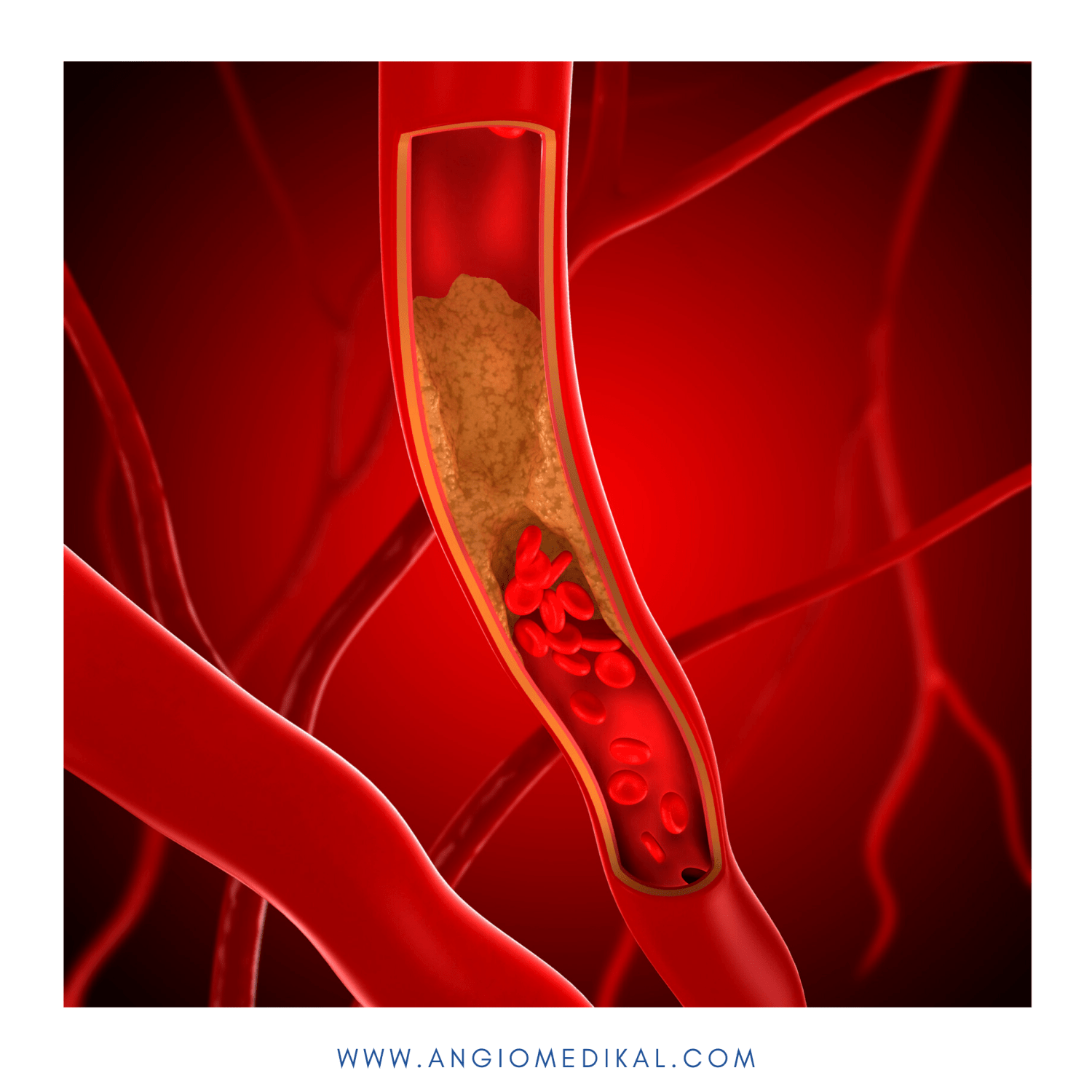 Enfermedad Carotidea – Angiología, Cirugía Vascular y Endovascular